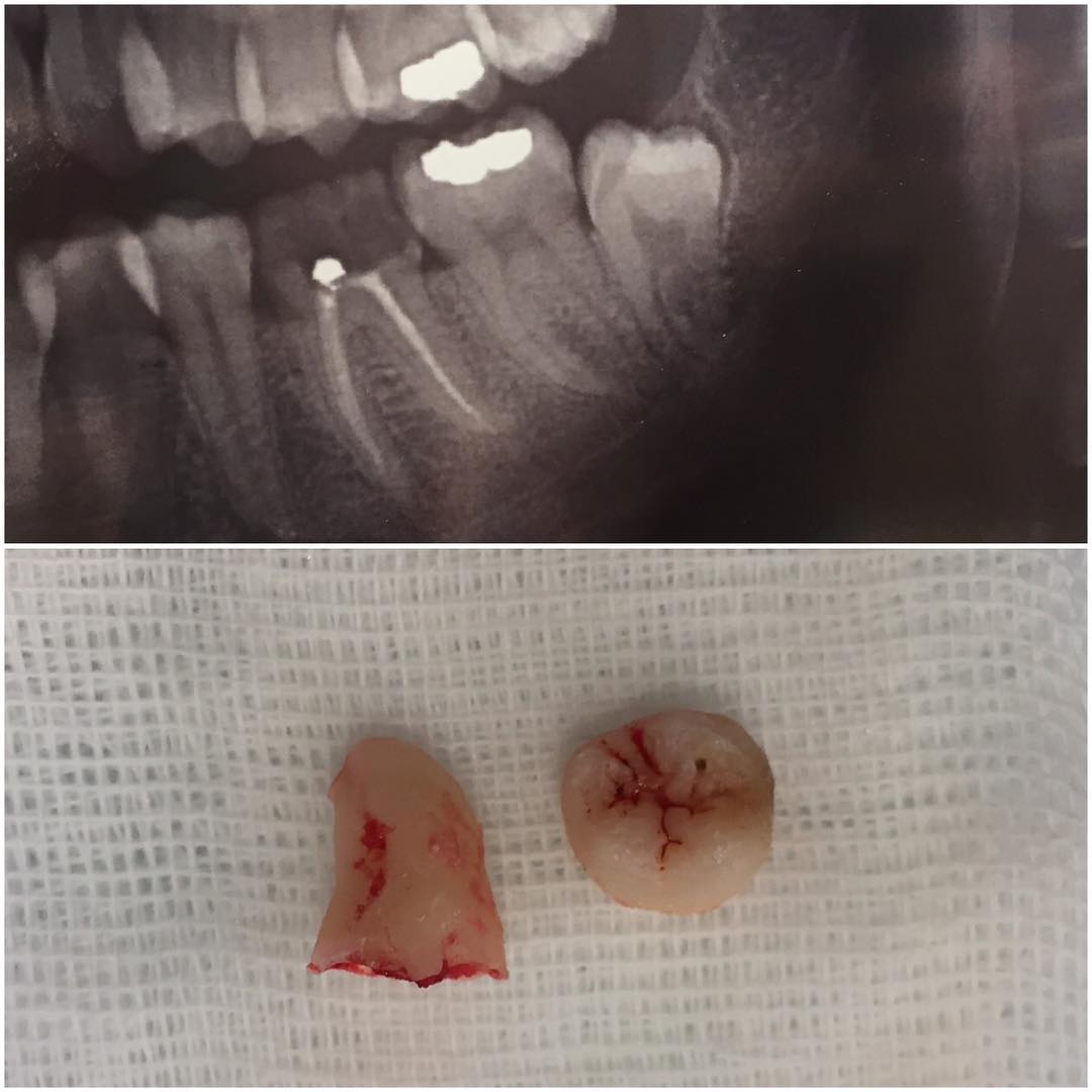 Distoangular lower third molar | جراح فک و صورت اصفهان
